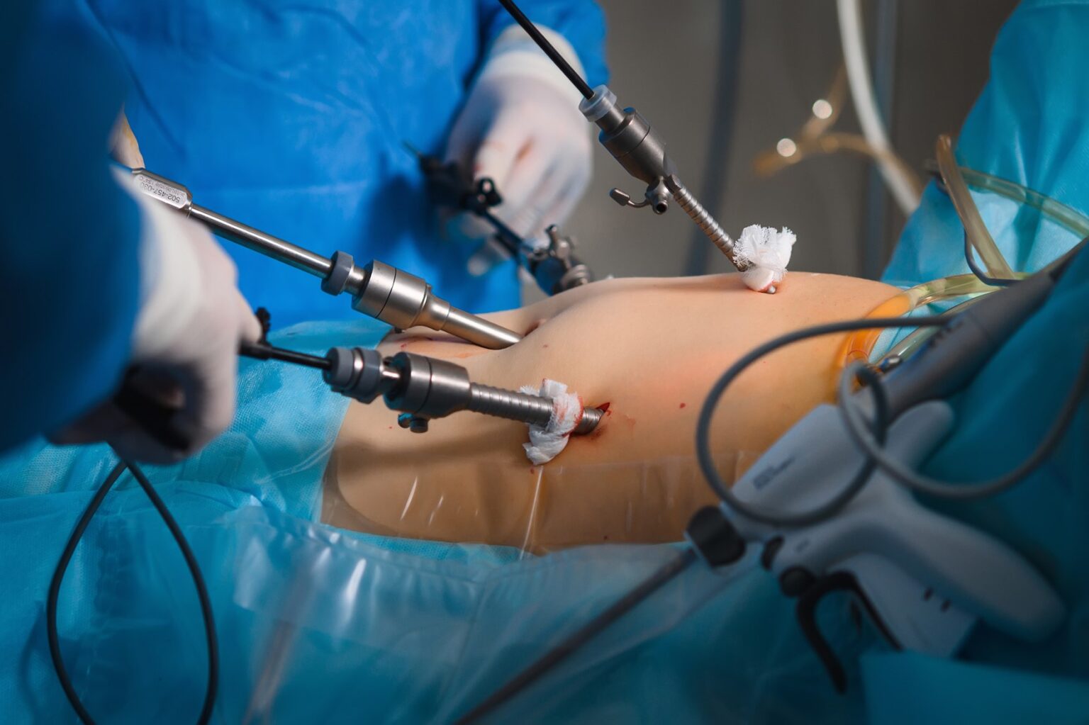 What Is A Laparoscopic Hysterectomy Dr Ankesh Sahetya What Is A Laparoscopic Hysterectomy Dr Ankesh Sahetya